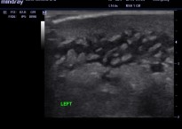 Diagnostic Ultrasound of the Foot and Ankle